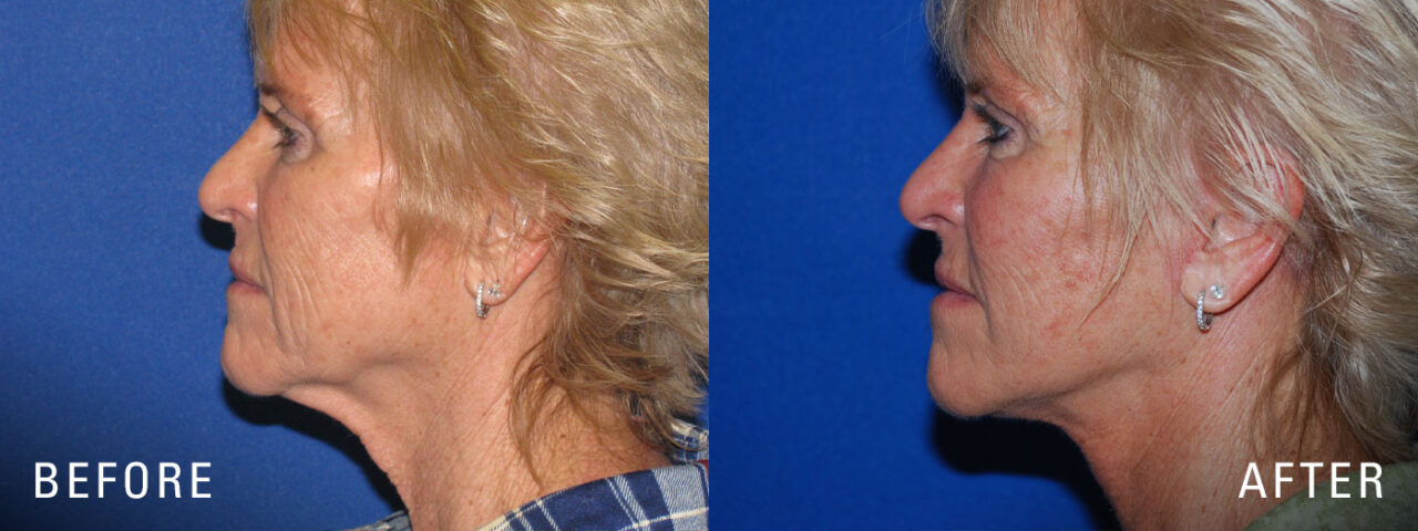 Facelift Before And After Photos Illume Cosmetic Surgery And Medspa