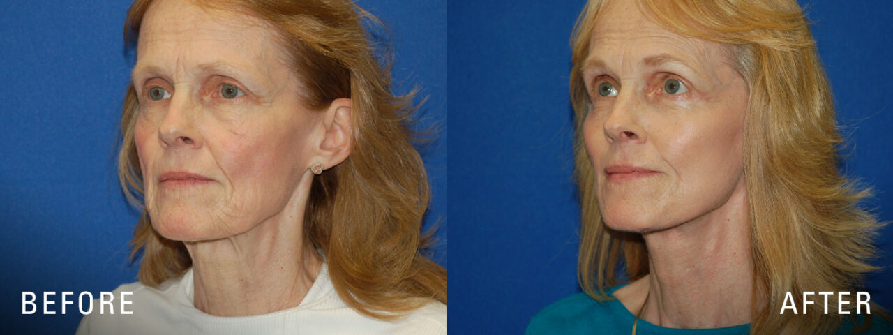 Facelift Before And After Photos Illume Cosmetic Surgery And Medspa