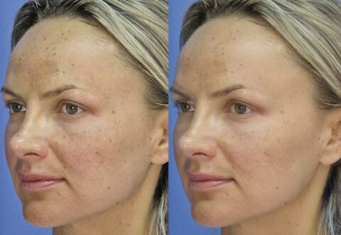 MicroLaser Peel | Illume Cosmetic Surgery & MedSpa