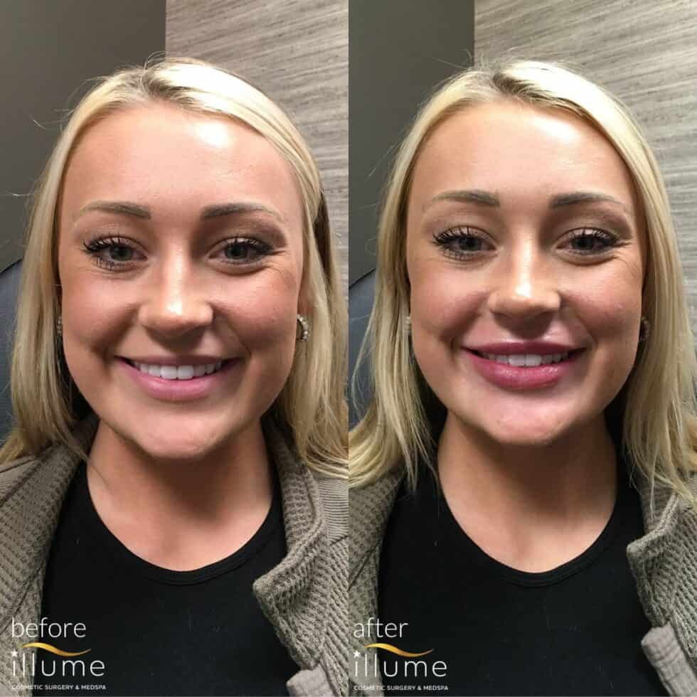 Before & After Lip Filler Injections | Illume Cosmetic Surgery & MedSpa
