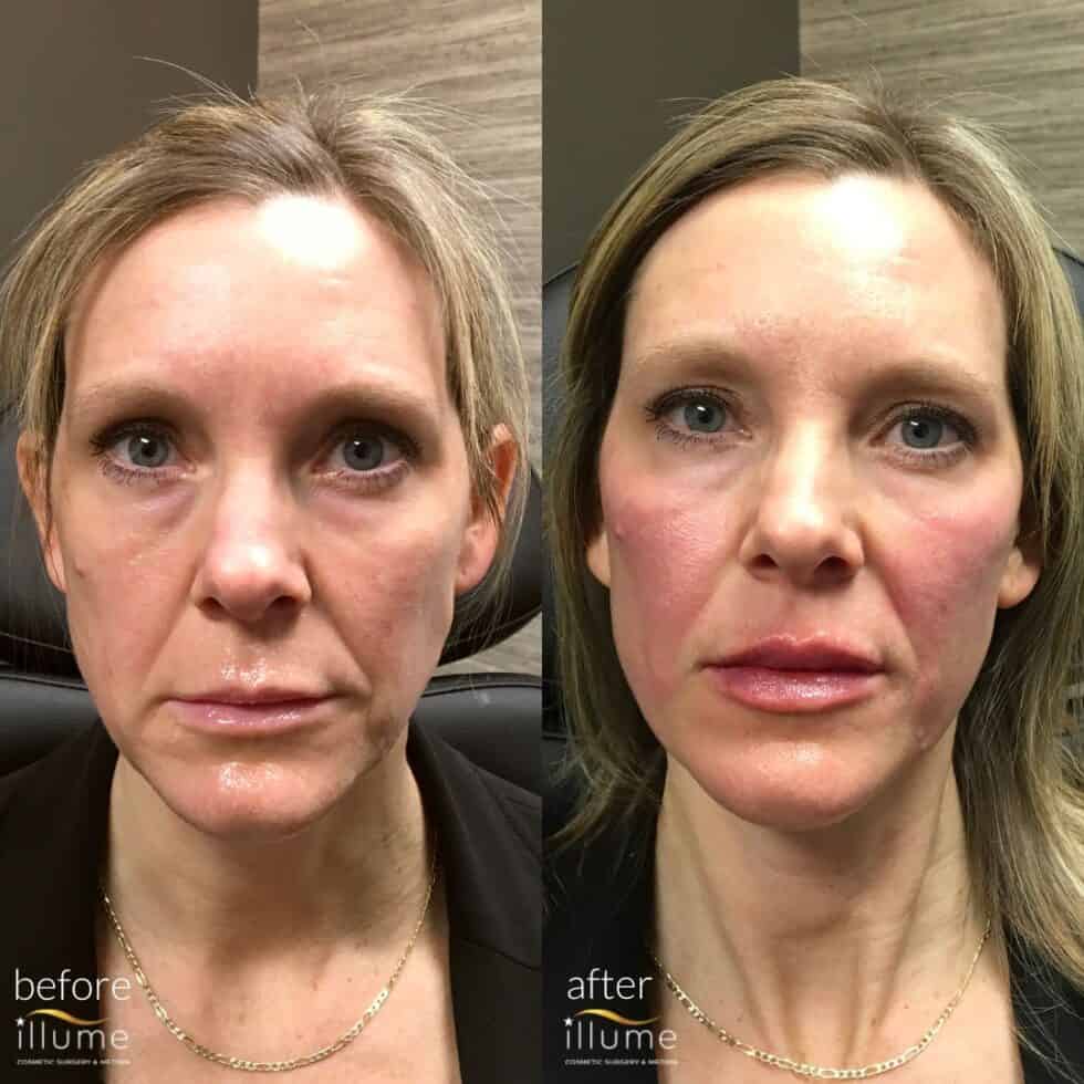 Lip Filler - Illume Cosmetic Surgery & MedSpa