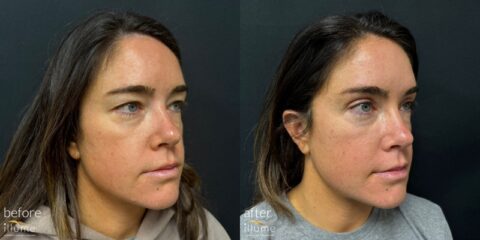 Eyelid Surgery Before & After | Illume Cosmetic Surgery & MedSpa
