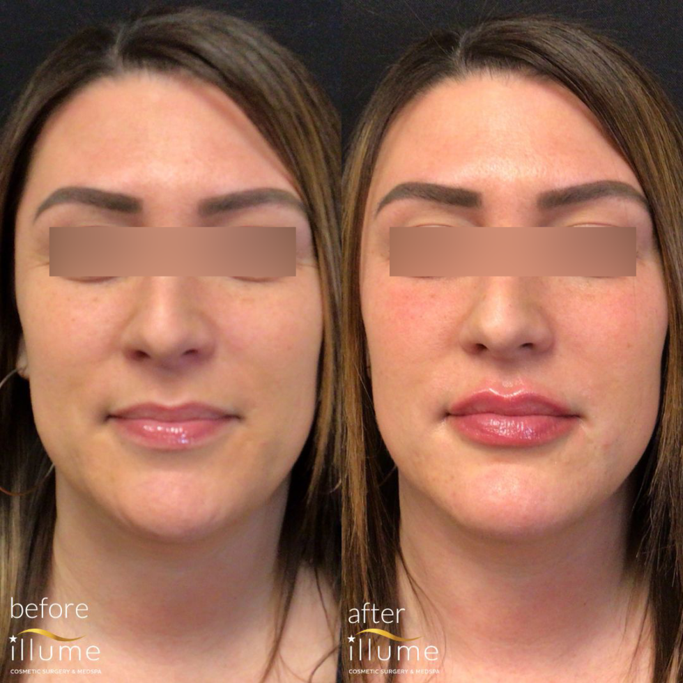 Lip Filler In Milwaukee Illume Cosmetic Surgery And Medspa