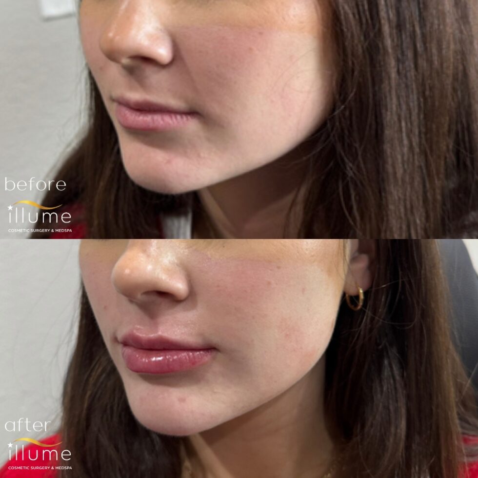 Lip Filler Prices & Services in Menomonee Falls | Illume Cosmetic